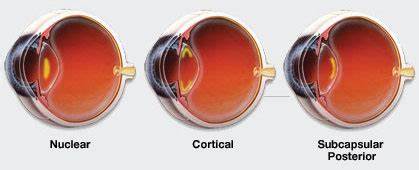 Clínicaibm.com: Tipos de cataratas