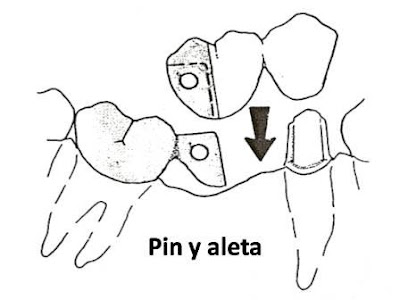 PROTESIS DENTAL : PONTICO