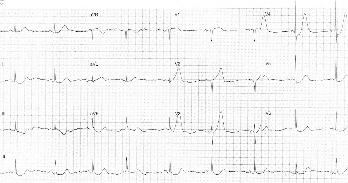 ECG of the Week: ECG of the Week - 21st March 2016 - Interpretation