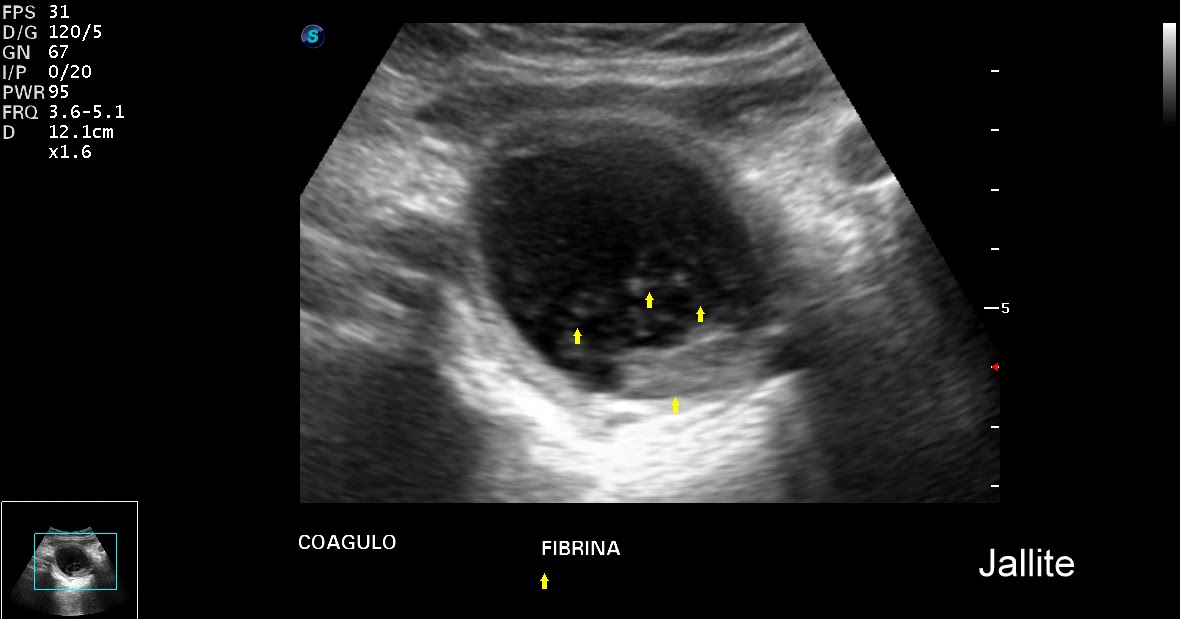 Cistitis Hemorragica Aguda