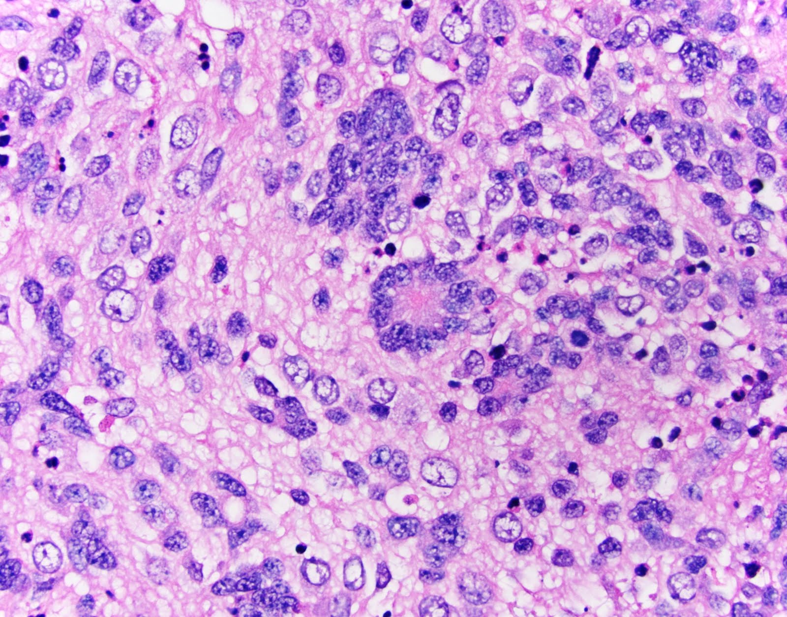 neuropathology blog: True rosette situated within an Embryonal Tumor ...
