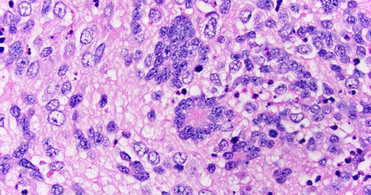 neuropathology blog: True rosette situated within an Embryonal Tumor ...