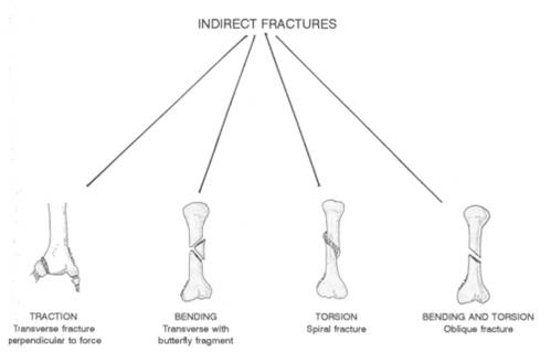 Closed Fracture - My TimeLine