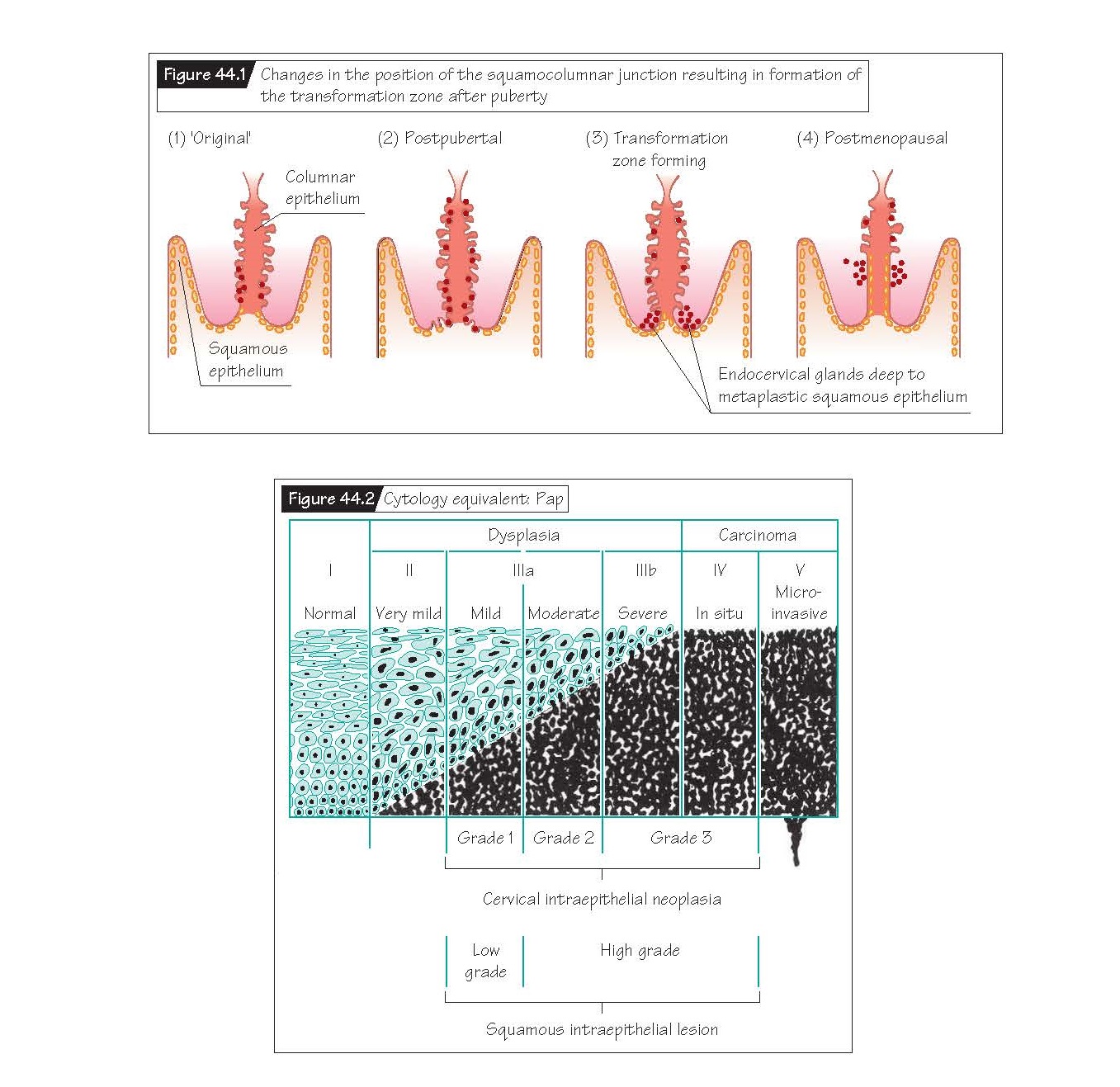 Cervical Cancer - pediagenosis