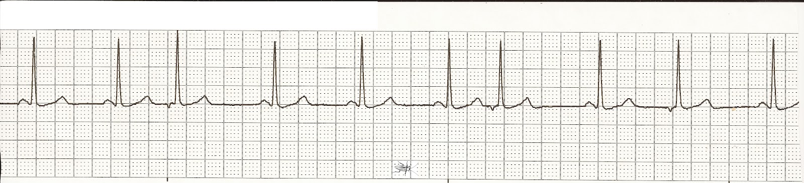 EKG Rhythm Strips 05