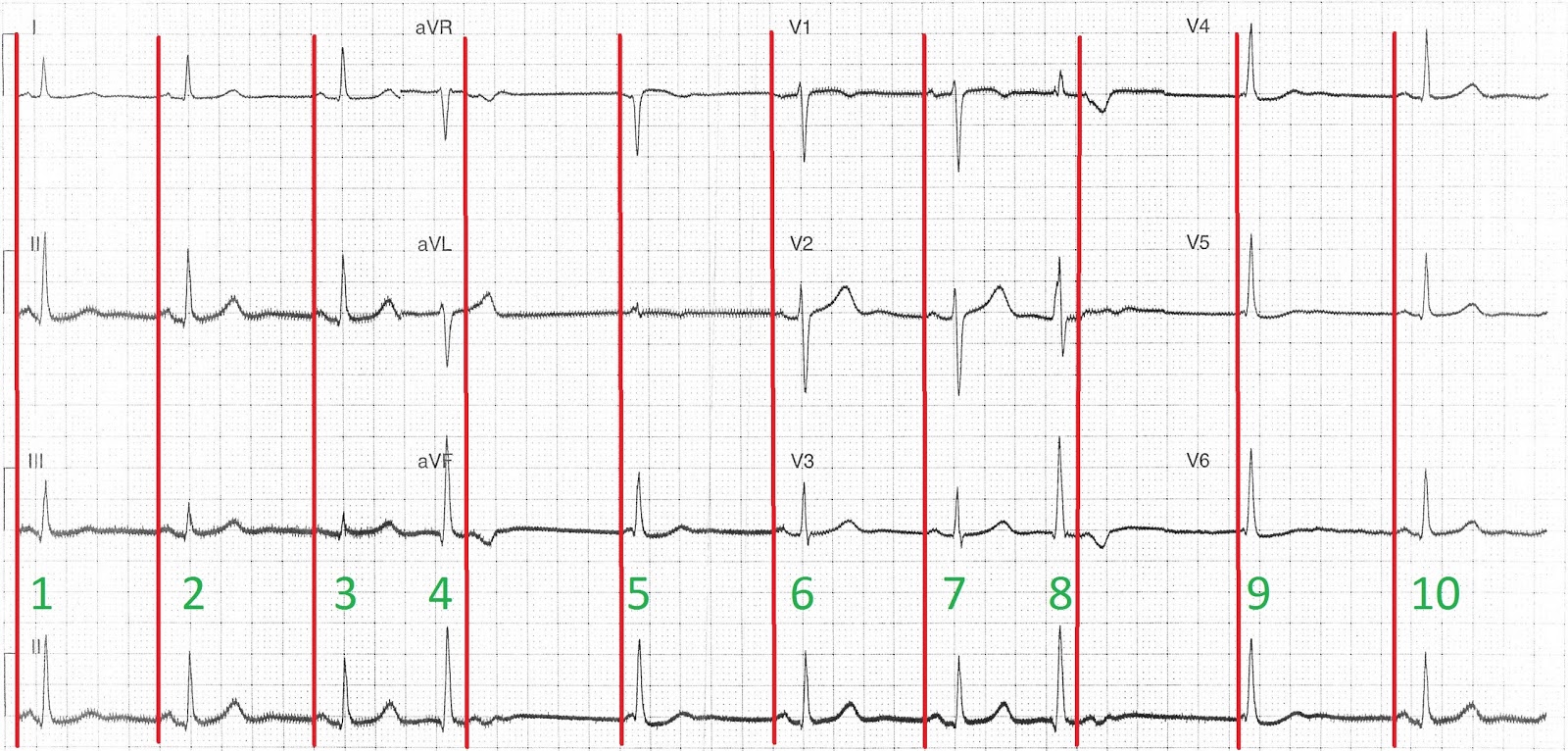 ECG of the Week: ECG of the Week - 14th December 2015 - Interpretation