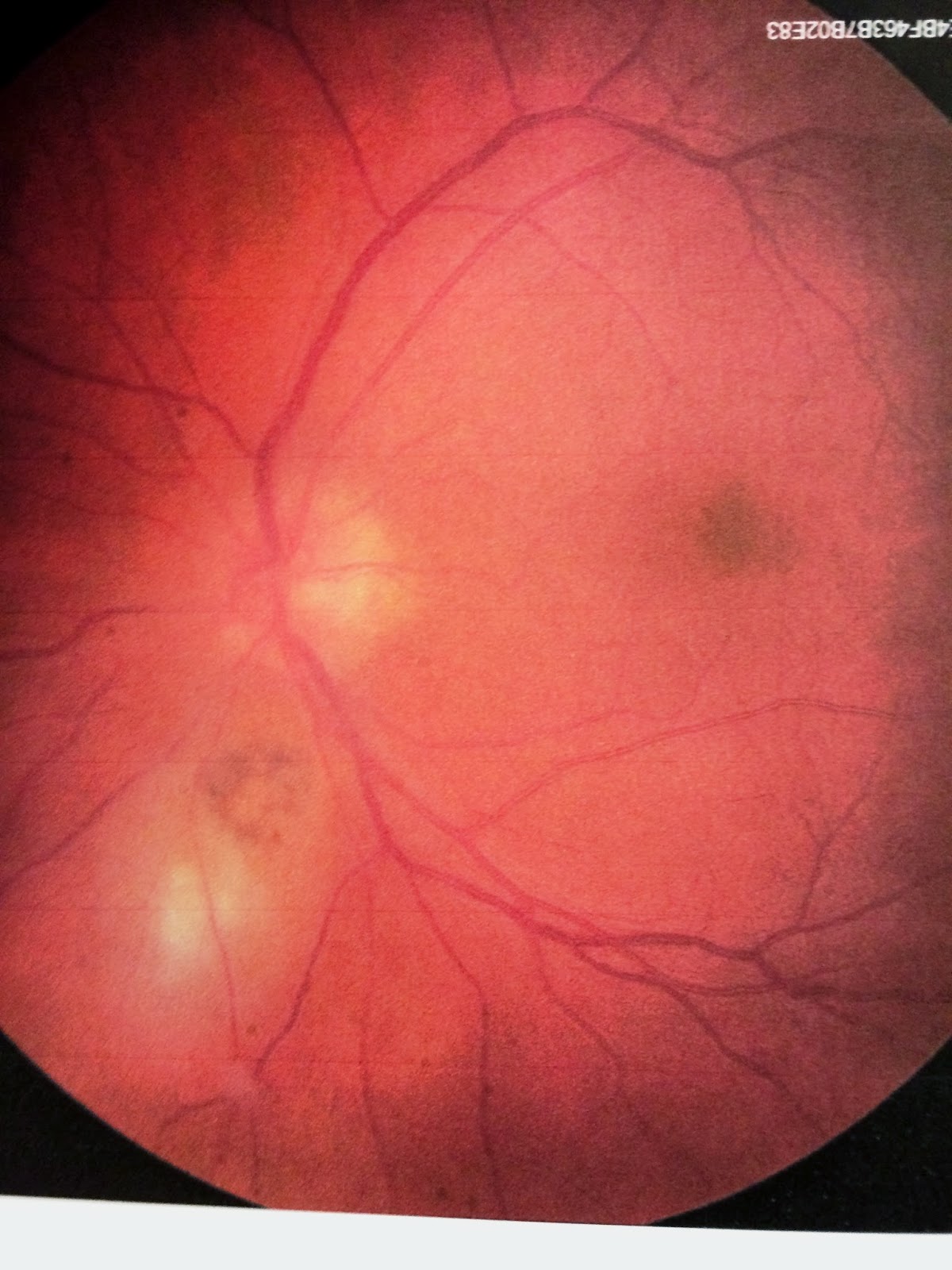 Diagnose My Retinal Photograph: Inflammatory Retinal Disease Edition ...
