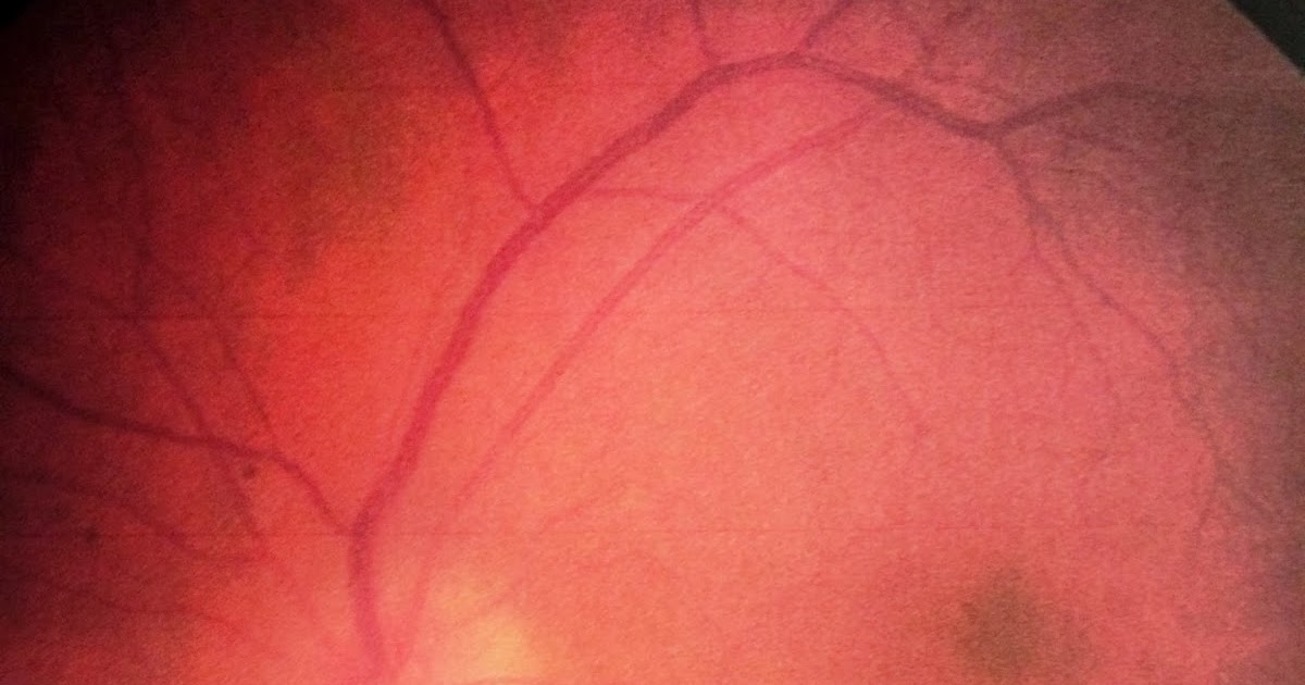 Eyedolatry: Diagnose My Retinal Photograph: Inflammatory Retinal ...