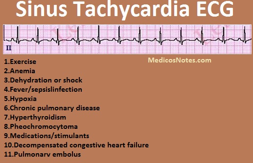 Tachycardia Pulse Rate