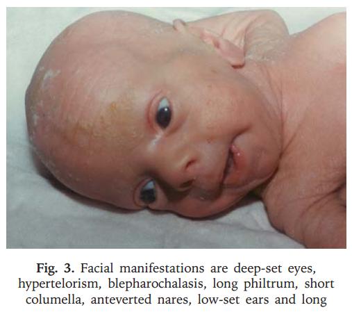 Health and Fitness Network: Cutis Laxa