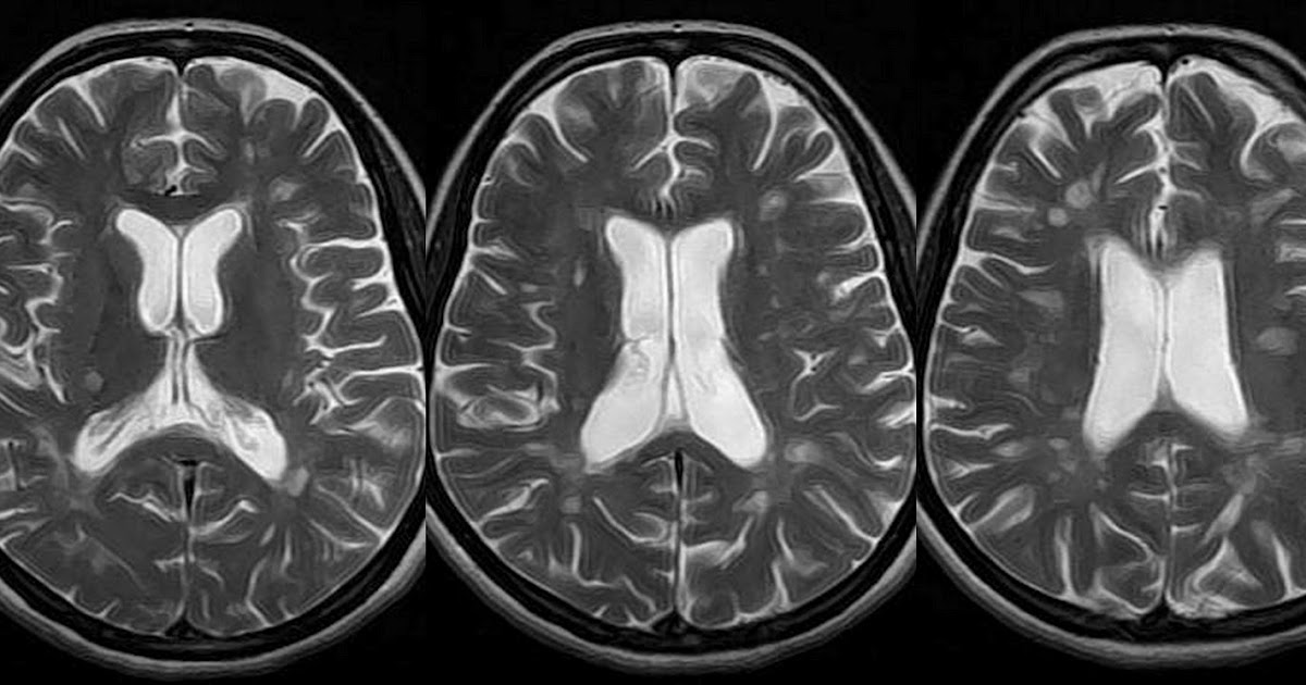 Neuroradiology Cases Multiple Sclerosis Axial Vs Sagittal T2
