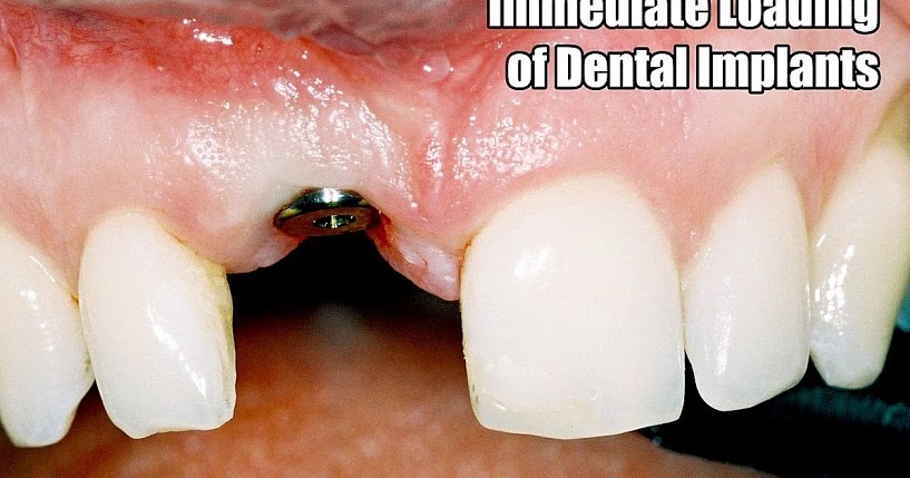 VIDEOCONFERENCING: Immediate Loading of Dental Implants: How to ...