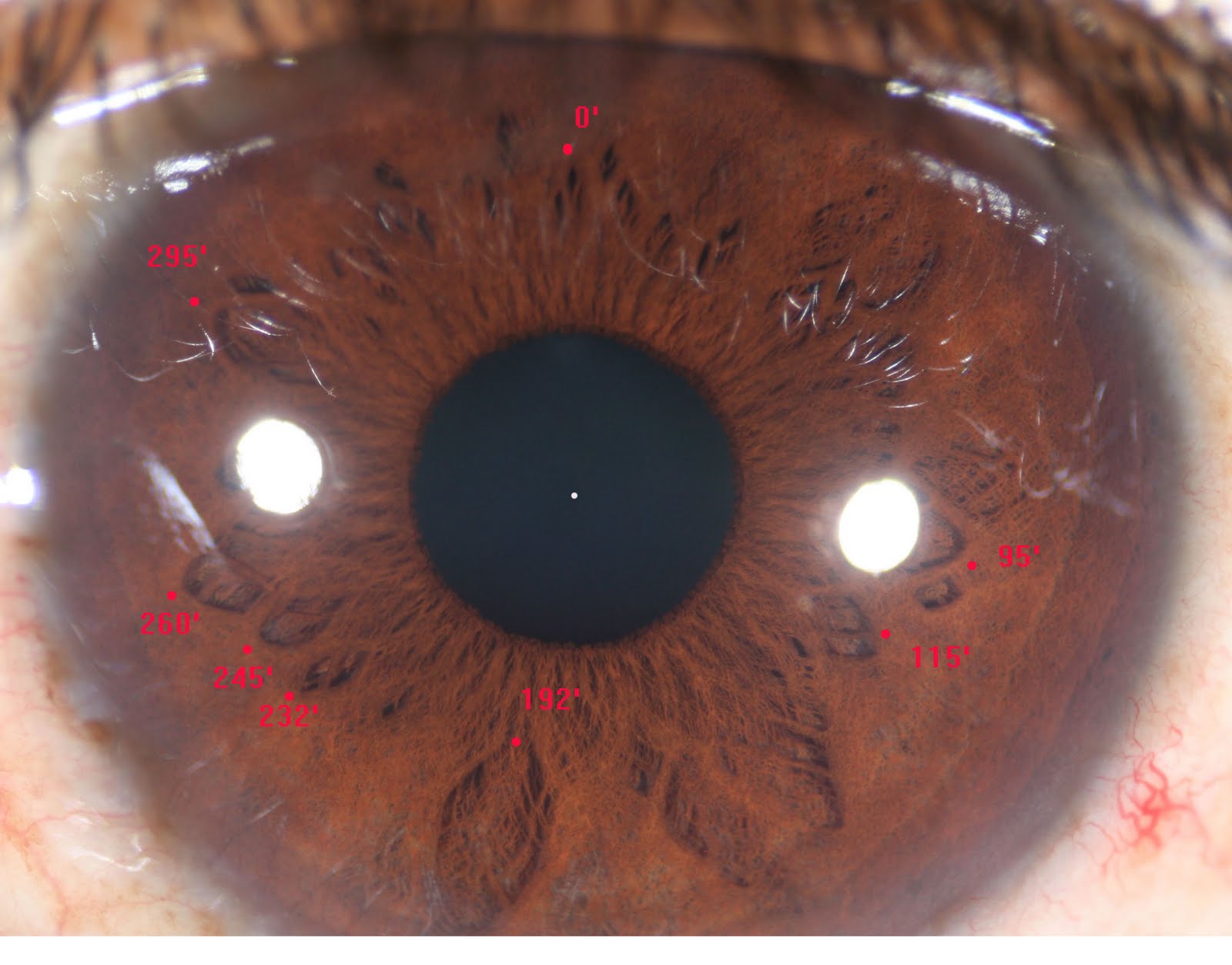 Modern & Multidimensional Iridology: Importance Structural Signs in ...