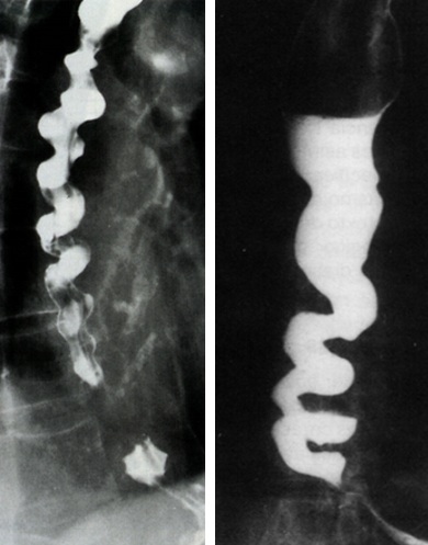 ESPASMO ESOFÁGICO – Raquel Luiza.com