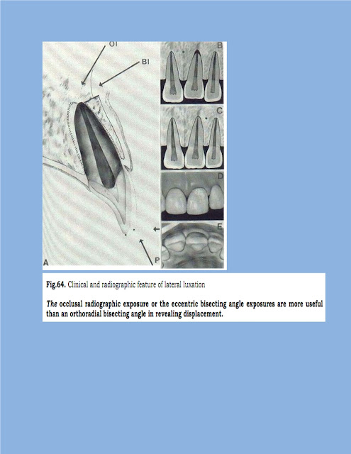 DOs and DONTs in DENTISTRY: CONCUSSION ,SUBLUXATION,EXTRUSION ,LATERAL ...