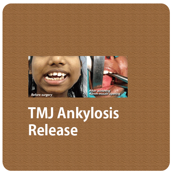 TMJ Ankylosis release - Richardson dental and craniofacial Hospitalposts