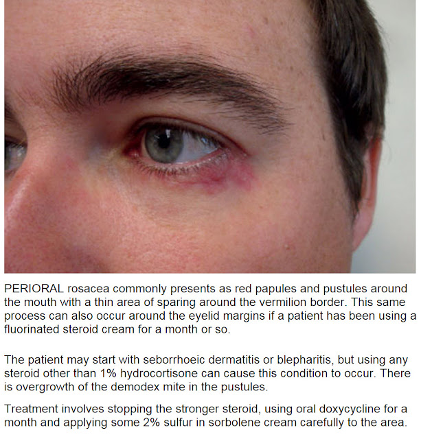 Consultations in Dermatology: Periocular rosacea