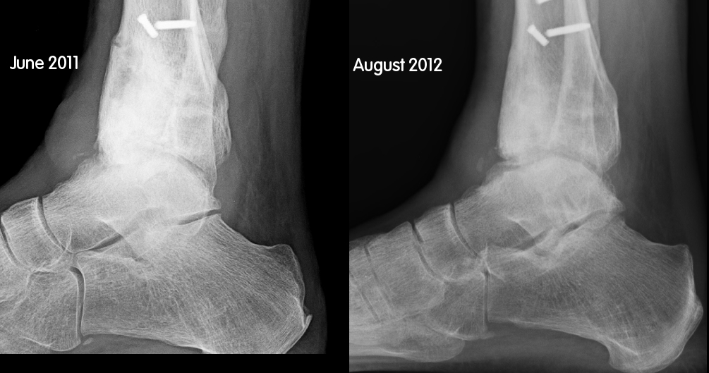 Snowboarder vs. Tree: Snowboarder vs. Ankle Distraction Arthroplasty