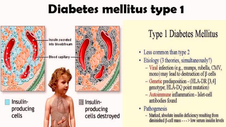 Type 1 Diabetes Prognosis And Pathophysiology - Diabetes Suport