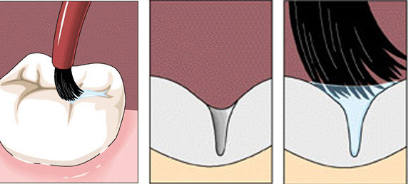 Pit and Fissure Sealant ~ Dr. Bharat Katarmal Dental & Implant Clinic