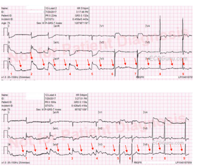 ECG Interpretation: ECG Interpretation Review #143 (ECG Guru - Dawn ...