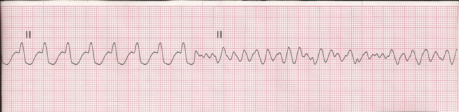 ACLS Rhythms: Ventricular rhythms