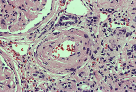 Pathology Cases: Block 2 Case 7 Answers - Vascular