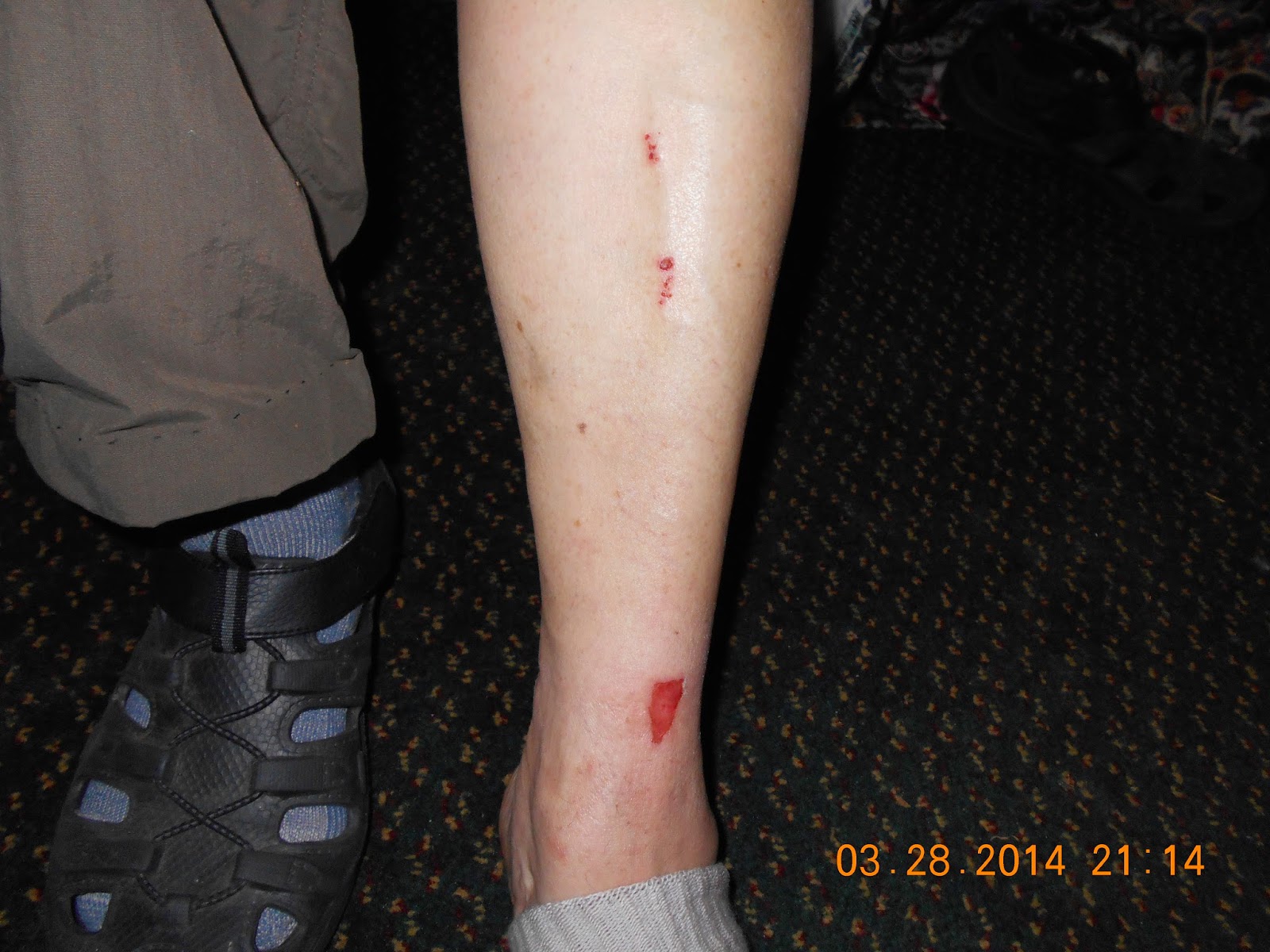 Post War Hike: Battle Scars