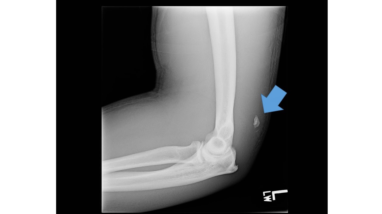 Shoulder and Elbow Surgery: Distal triceps ruptures in athletes ...