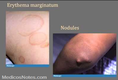 Subcutaneous Nodules Rheumatic Fever