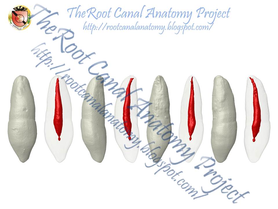 The Root Canal Anatomy Project: Peg-Shaped Lateral Incisors (Conoid)