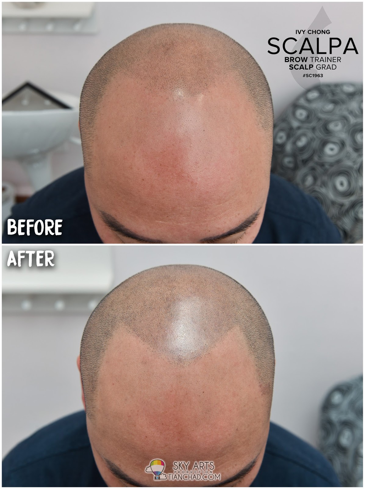 Best Scalp Micropigmentation (SMP) in Malaysia | SMP 让你不再为秃头而烦恼