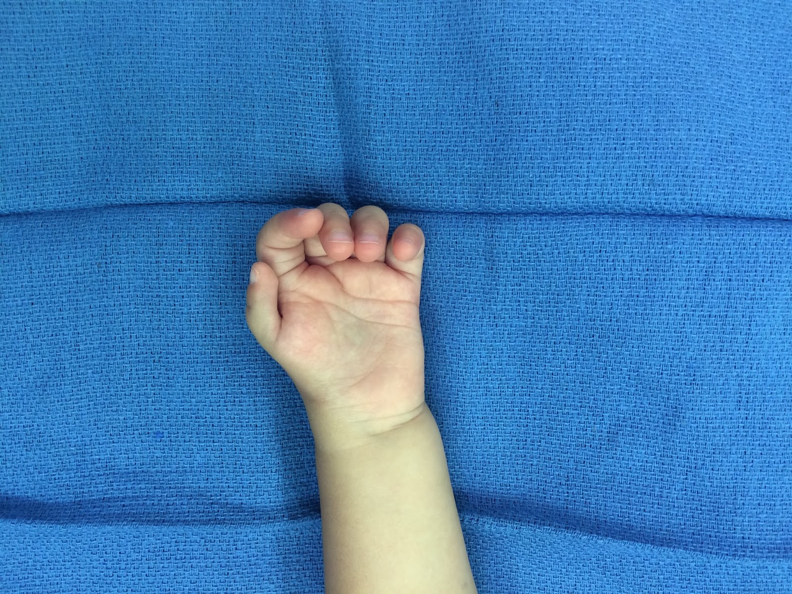 Pollicization- concerns immediately after surgery | Congenital Hand and ...