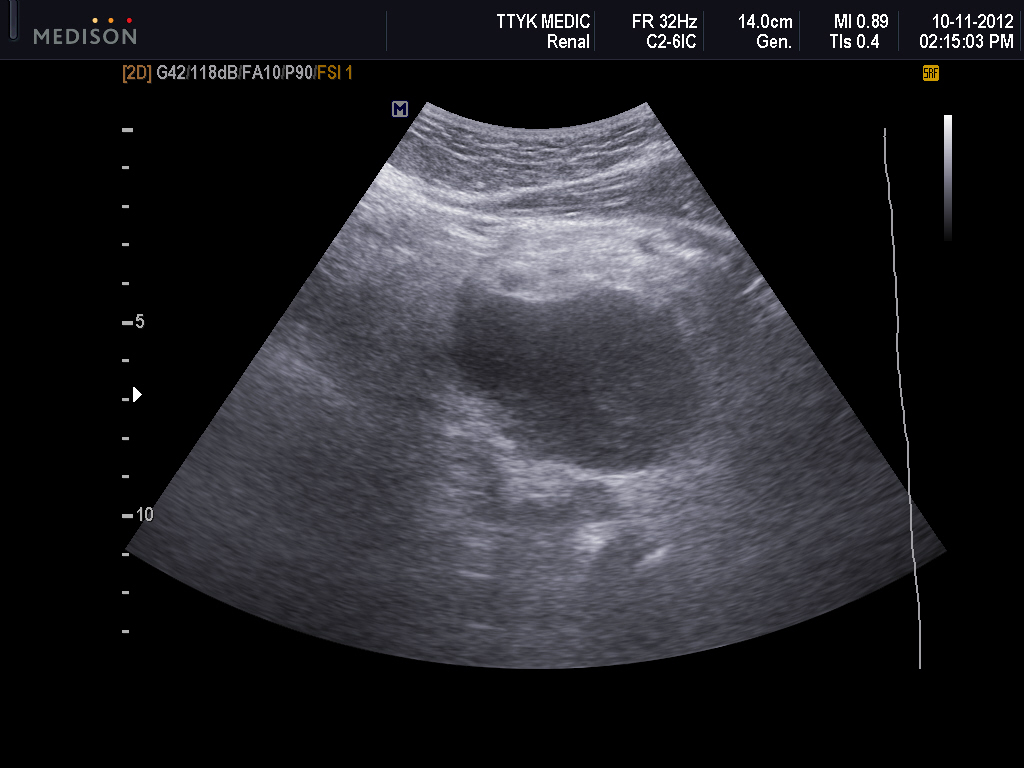 VIETNAMESE MEDIC ULTRASOUND: CASE 150: PERIUMBILICAL MASS, Dr PHAN ...