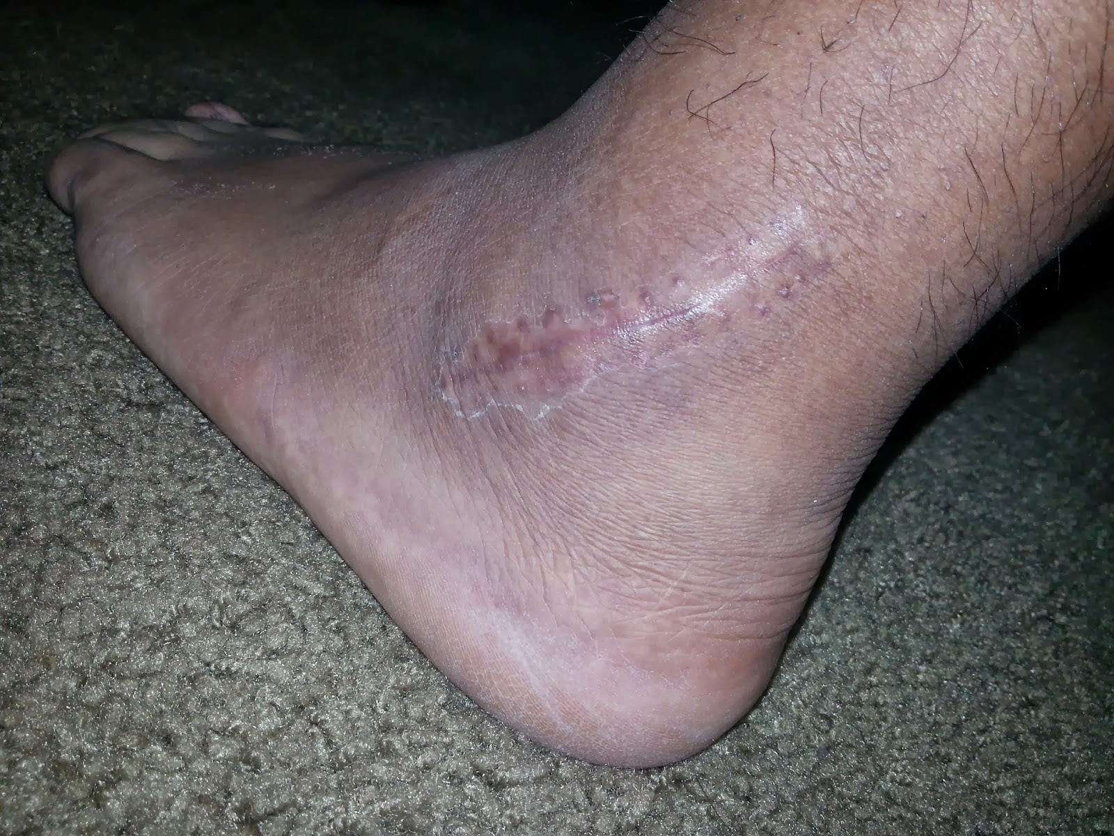 Peroneal Tendon Surgery Recovery: Ankle Time Line (updated for week 10/11)