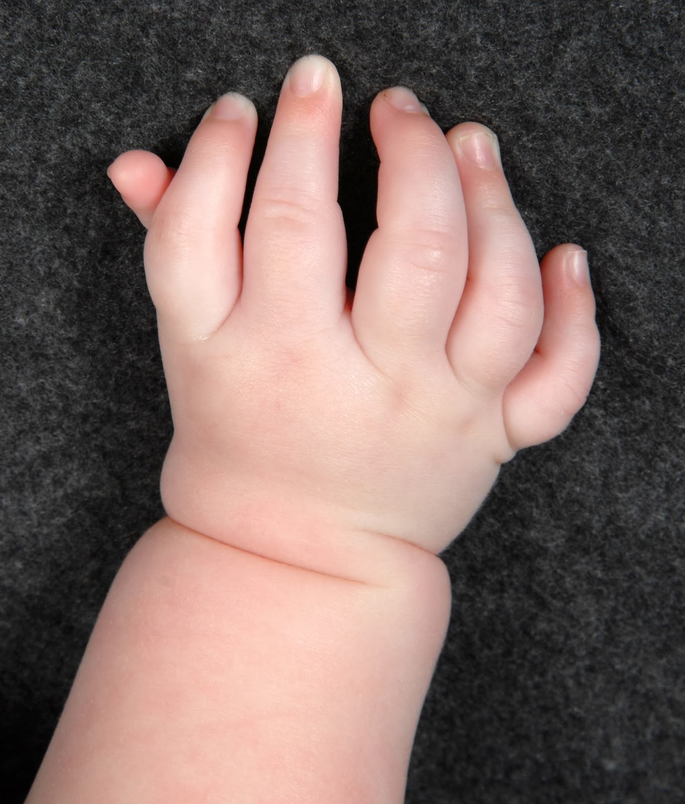5- finger hand, follow- up | Congenital Hand and Arm Differences ...
