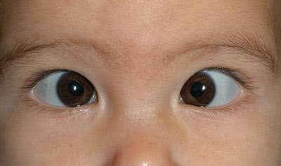 Optometrists: Inside Deviation of the Eye in Childrens