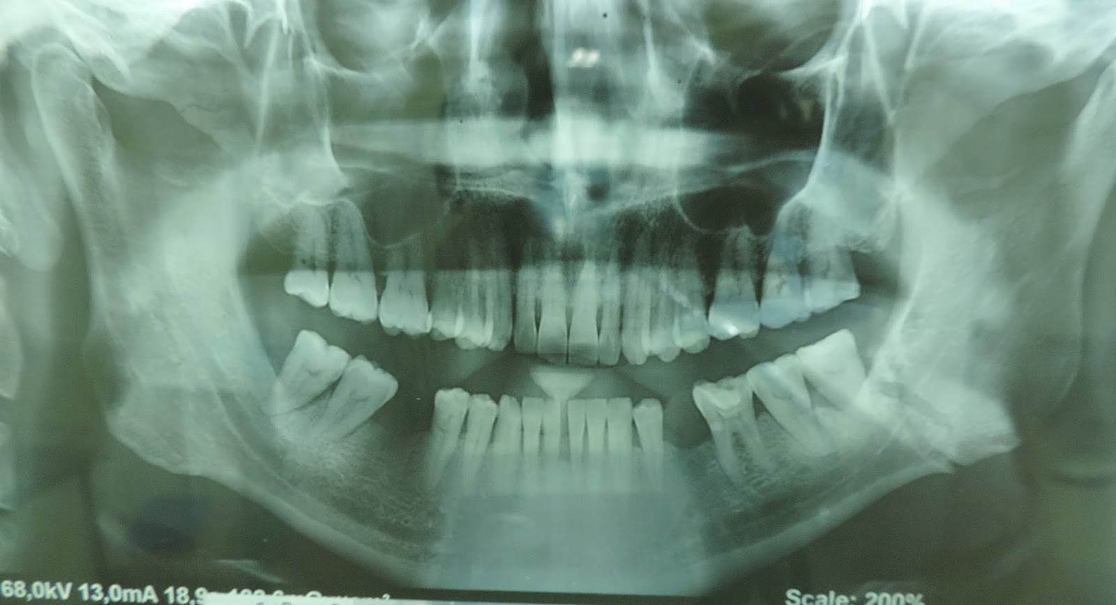 Fratura de Ângulo Mandibular - CIRURGIA BUCOMAXILOFACIAL