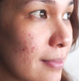 TOPAZ HORIZON: Pimply skin managed! Thanks, Flawless Acne Control ...