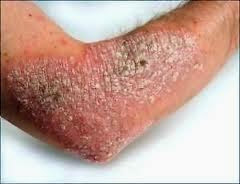 Artikel Kesehatan: Penyebab Koreng Dan Cara Mengatasinya