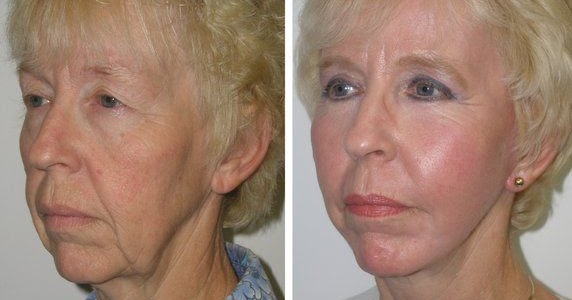 Facial Aerobics Exercises For Men And Women: Before And Afterward: Do ...