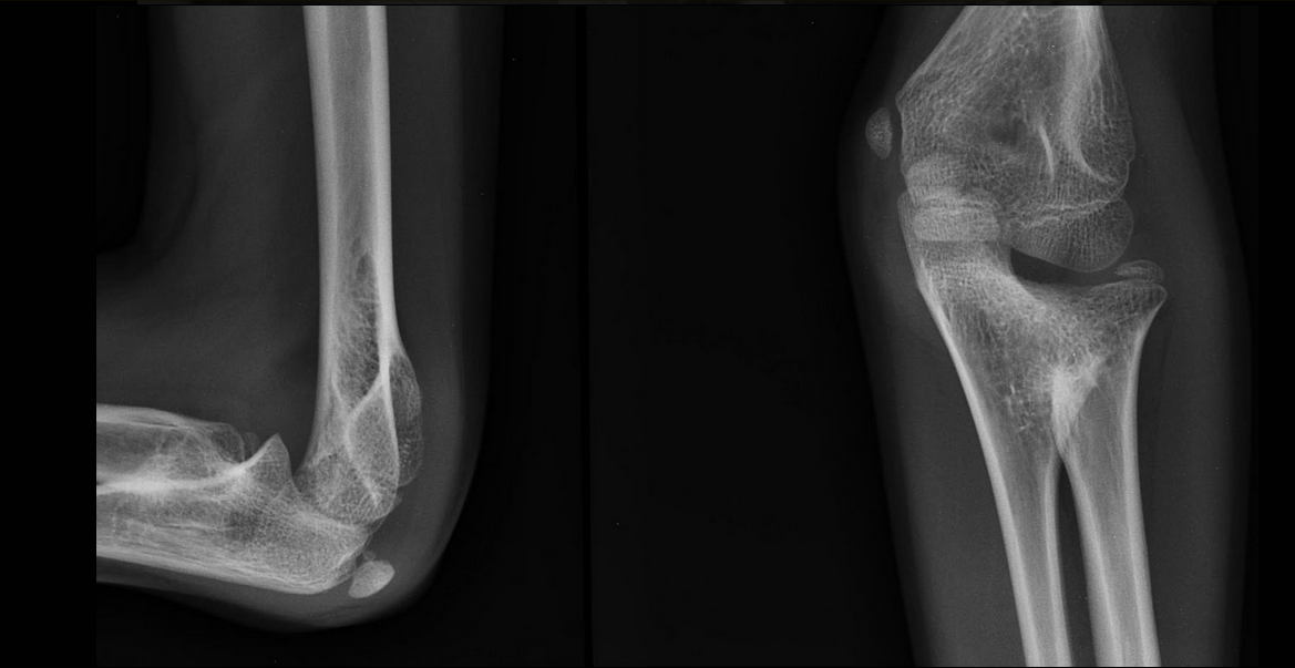 11:50: SINOSTOSIS RADIOCUBITAL POSTRAUMÁTICA