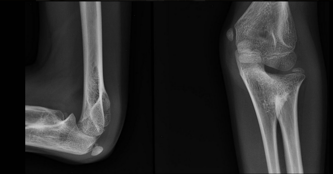 11:50: SINOSTOSIS RADIOCUBITAL POSTRAUMÁTICA