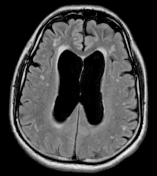 Tangents: NPH: Not Neil Patrick Harris, Normal Pressure Hydrocephalus