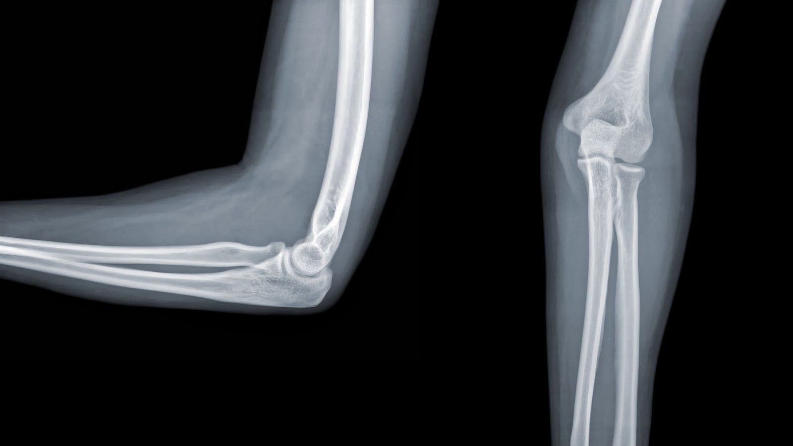 The Elbow: Diagnostic Imaging Approach | El Paso, TX.