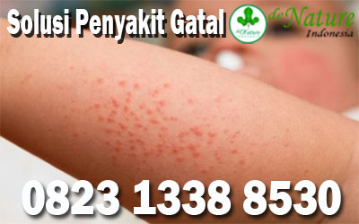 Obat Gatal Scabies Tradisional Yang Sudah Teruji Ampuh | Obat Khusus Gatal