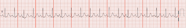 EKG Rhythm Strips: Hyperkalemia part 1