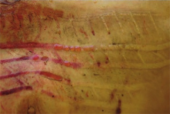 Deformutilation: Postmortem Patterned Abrasions