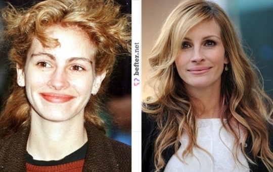 Julia Roberts Plastic Surgery Before and After Botox Injection and Nose ...