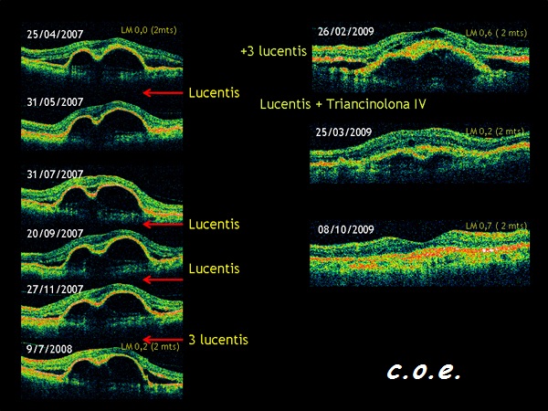 DEGENERACION MACULAR : DIAGNOSTICO PRECOZ___OCT